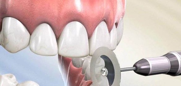 What Does IPR Mean In Orthodontics - Dailytoothcare.com