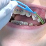 How To Remove Orthodontic Brackets - Dailytoothcare.com
