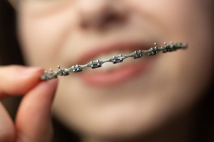 What Is The Role Of Power Chain In Orthodontics - Dailytoothcare.com